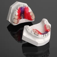 Beugel – Apeldoorn Orthodontie Welgelegen